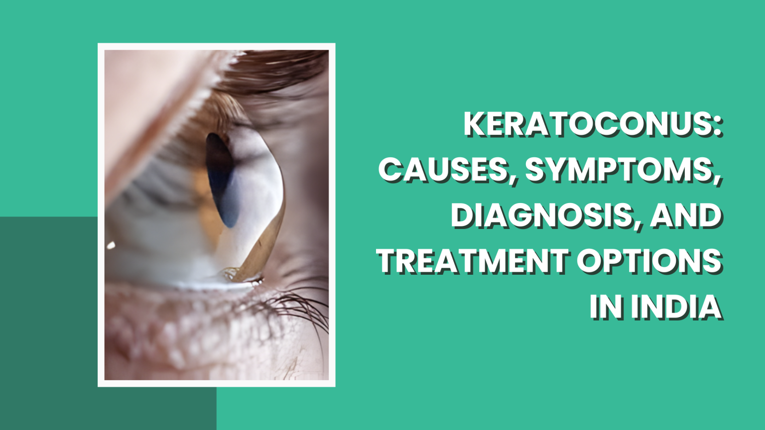Keratoconus: Causes, Symptoms, Diagnosis, and Treatment Options in ...